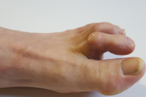 Should I Fix My Crooked Toes | Central Ohio Podiatrist | Foot & Ankle ...